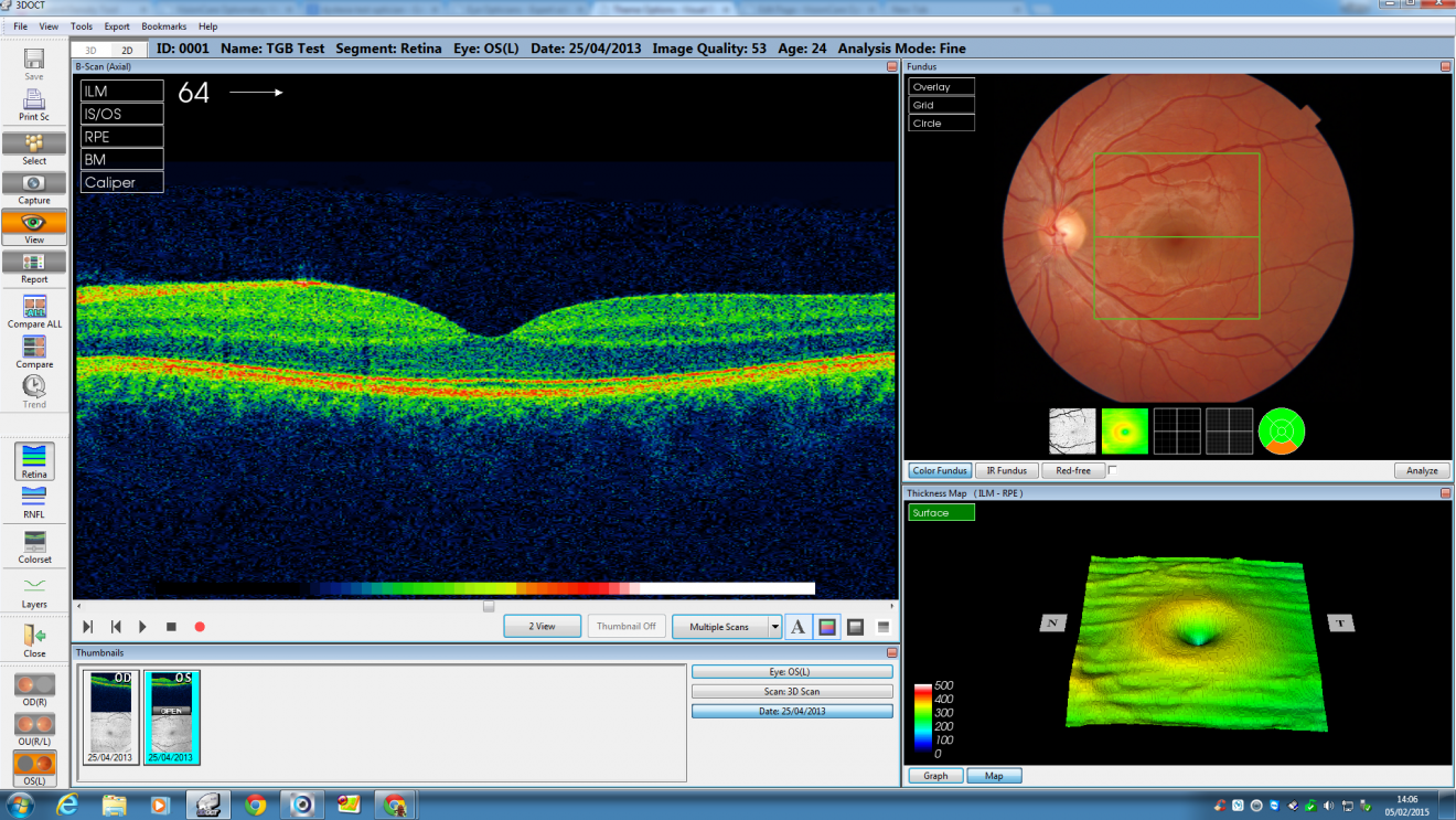 3d OCT Optical Coherence Tomography - Opticians in CastlefordVisionCare ...