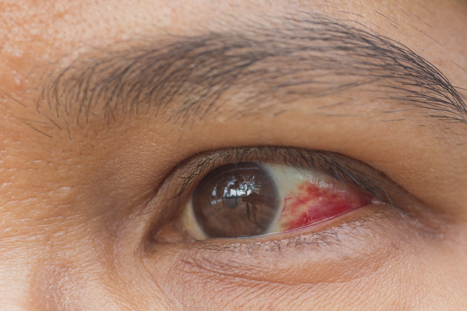 Minor Eye Conditions Service MECS VisionCare OptometryVisionCare